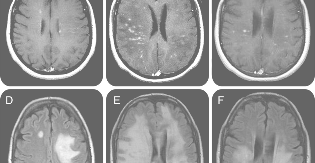 MULTIPLE SCLEROSIS AUTOIMMUNITY AND CLINICAL Cont. - Consult Dr. Anderson